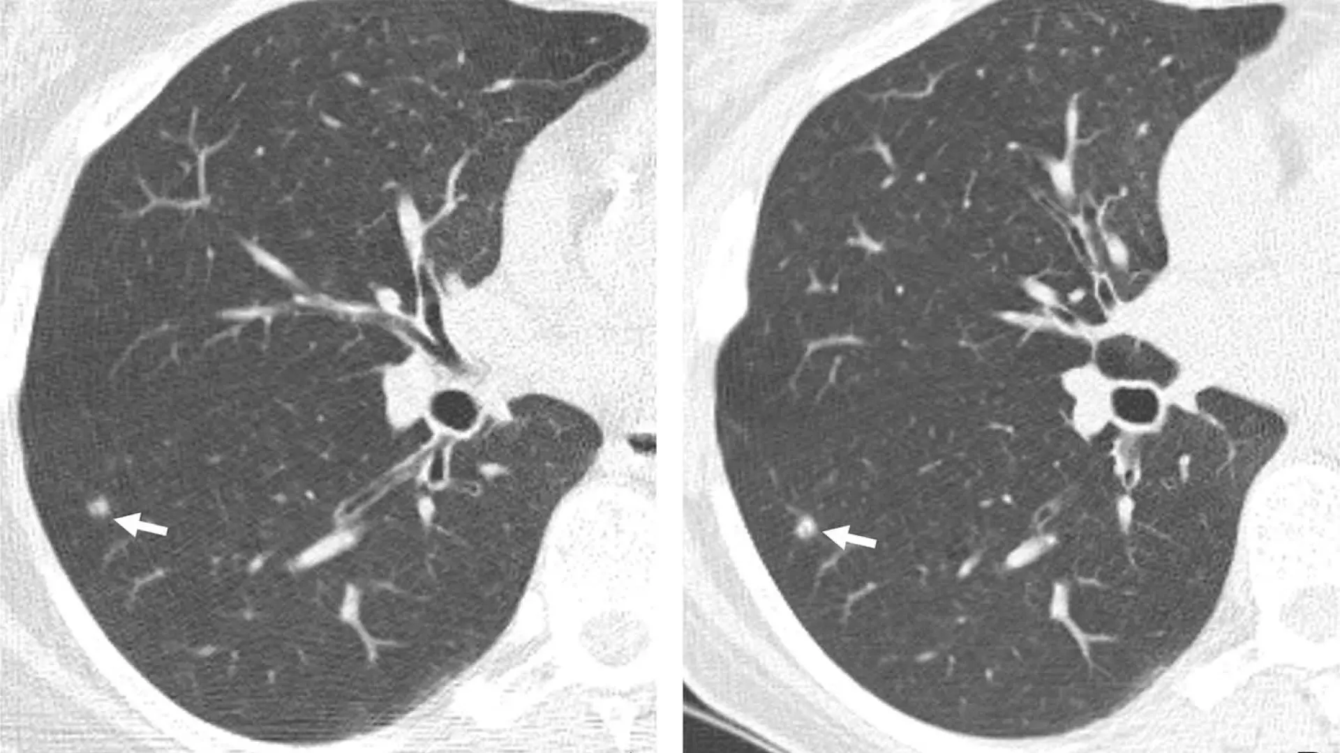 Cáncer de pulmón, un "tsunami" emocional que merma los recursos del 50% ...